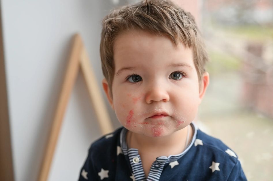 4 Unique Slapped Cheek Syndrome Risk Factors - AETHEION®